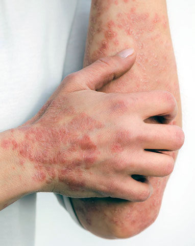 Dermatitis Seborreica En La Cara: Qué Es, Causas Y, 49% OFF
